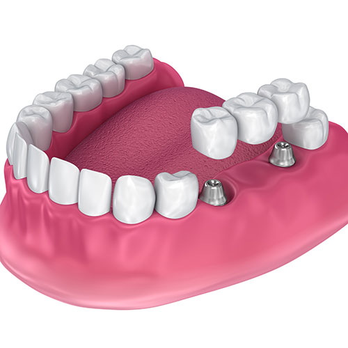 Brookline Dental Implant LP